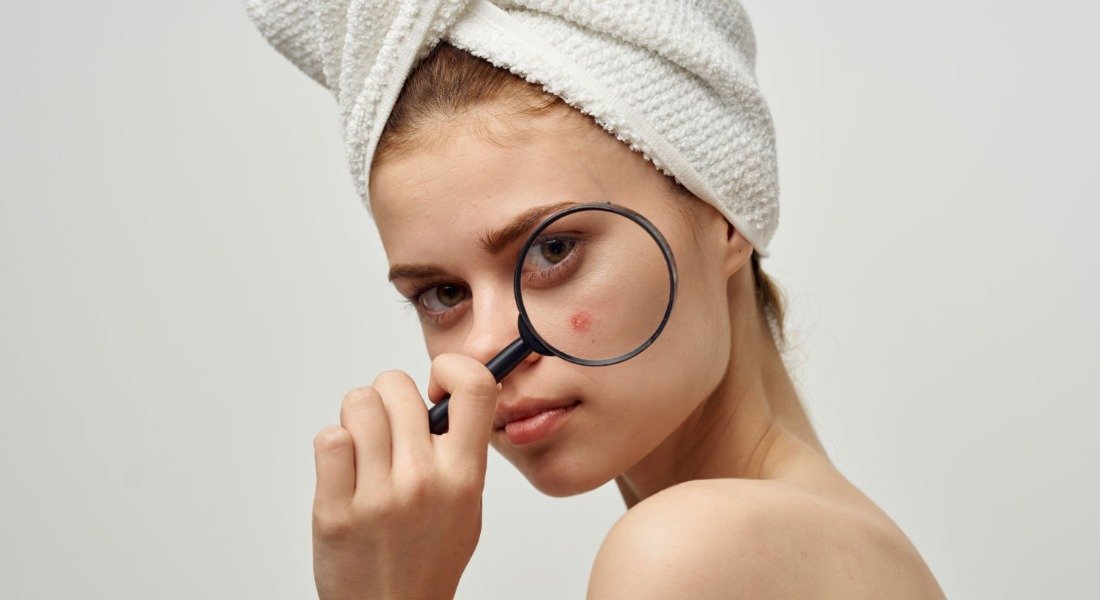 Αζελαϊκό οξύ: Το συστατικό που υπόσχεται να σε βοηθήσει με την ακμή – Makeleio.gr